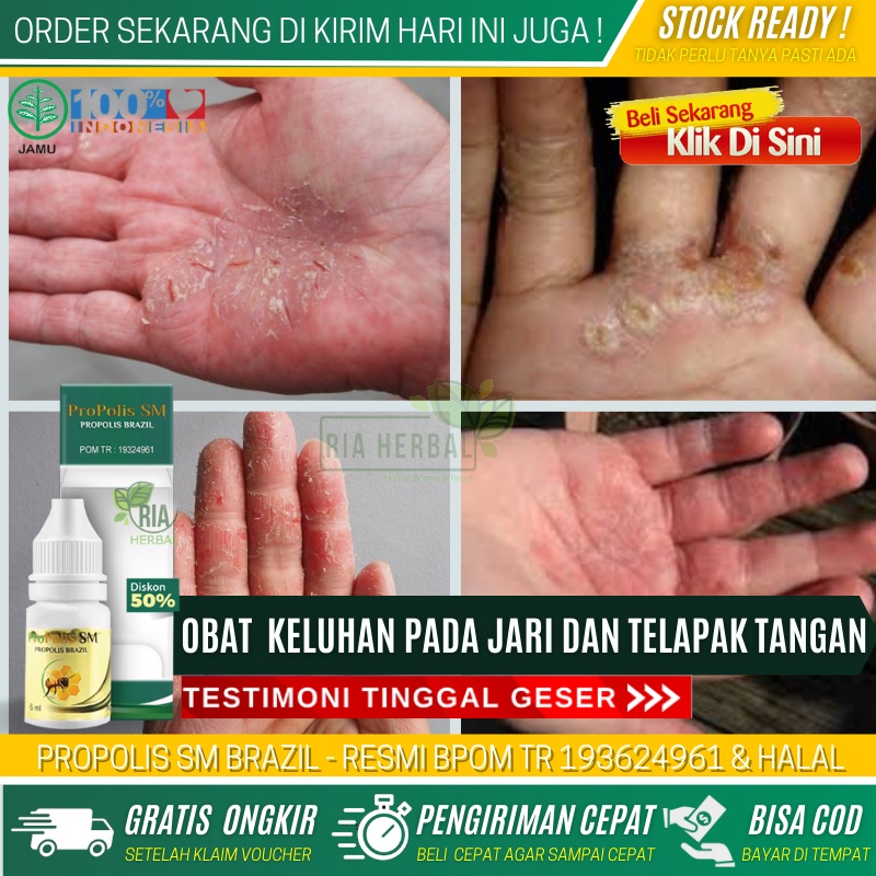 Jual OBAT TANGAN MELEPUH KARENA ALERGI SEMEN, SALEP KULIT TELAPAK ...