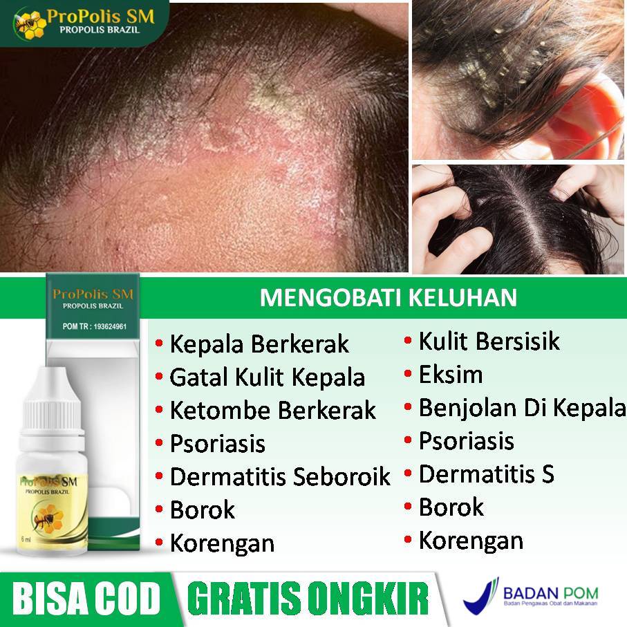 Jual Obat Gatal Kulit Kepala, Kulit Kepala Berkerak, Psoriasis, Ketombe Berkerak, Borok Di ...