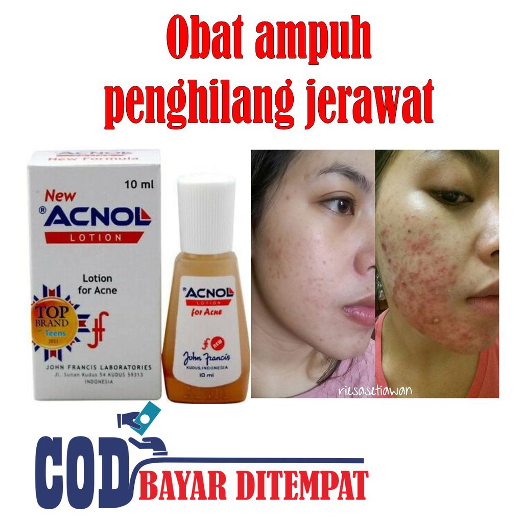 Jual Obat AMPUH Jerawat Acnol Lotion ASLI Original 100% Penghilang ...