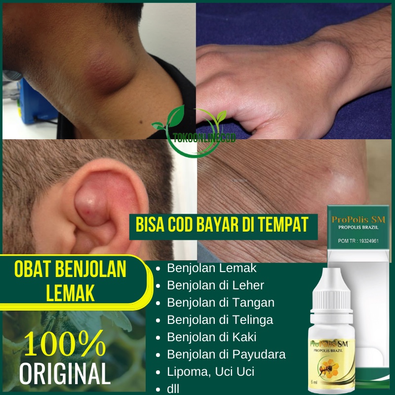 Jual Obat Benjolan Lemak di Leher Payudara di Tangan di Miss v, Obat ...