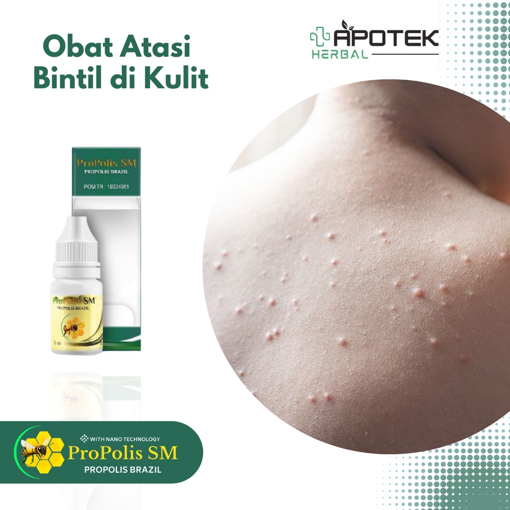 Jual Obat Bintil untuk Anak & Dewasa, Obat Bintilan di Kulit, Obat ...