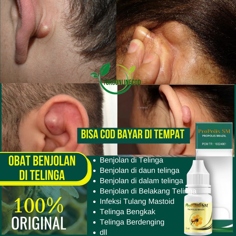 Jual Obat Benjolan di Telinga, Benjolan Belakang Telinga, Benjolan di ...