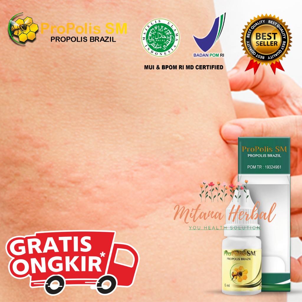 Jual MIAL obat biduran gatal alergi, obat bidural gatal kronis, obat ...