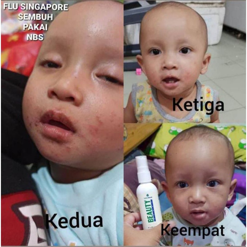 Jual Obat Ruam susu,gatal gatal,herpes dan masalah kulit lainnya,NATURA ...