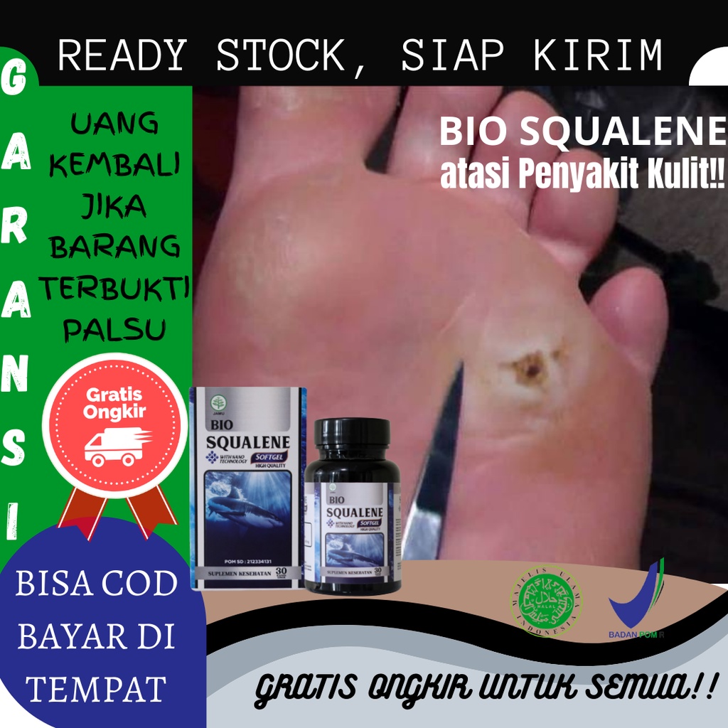 Jual Obat Untuk Mata Ikan Anak dan Dewasa, Obat Mata Ikan di Kaki, Obat ...