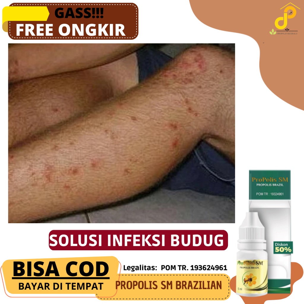 Jual Obat Budug di kaki,Penghilang bekas budug yang menghitam, Obat ...