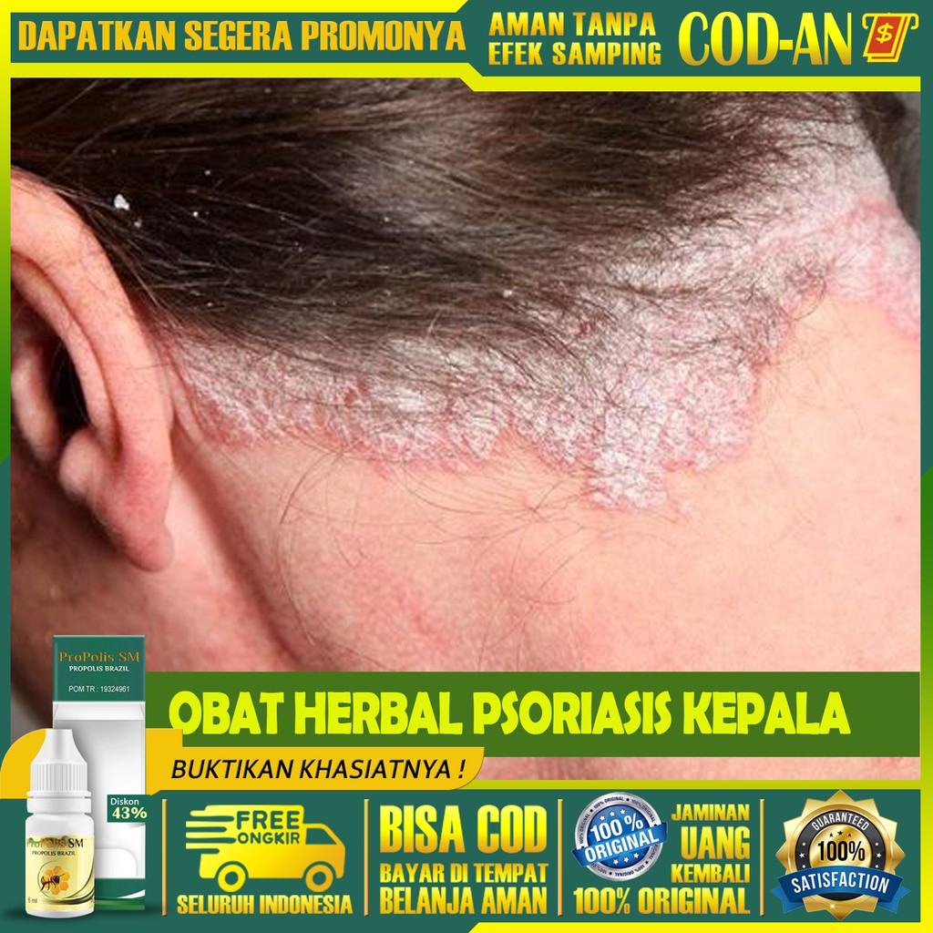 Jual Obat psoriasis, obat psoriasis kulit kepala, obat psoriasis gatal ...
