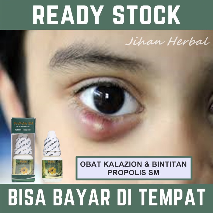 Jual Obat Kalazion - Mata Bengkak - Mata Bintitan - Benjolan Di Kelopak ...