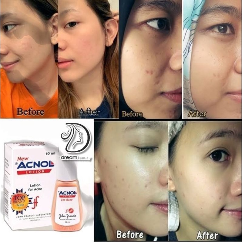 Jual Acnol Lotion obat jerawat 10ml / Acnol lotion for acne | Shopee ...