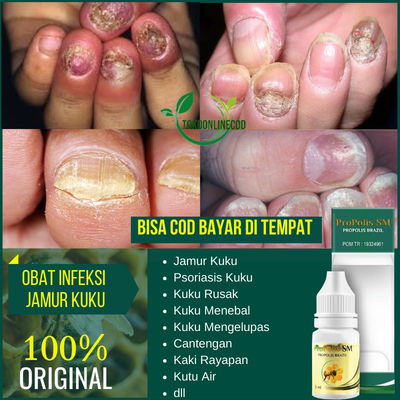 Jual Obat Jamur Kuku Psoriasis Kuku Rusak Jamur Kuku Kaki Tangan ...