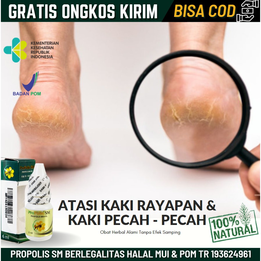 Jual OBAT KAKI RAYAPAN - KAKI PECAH - PECAH KERING KULIT MATI KERAS ...
