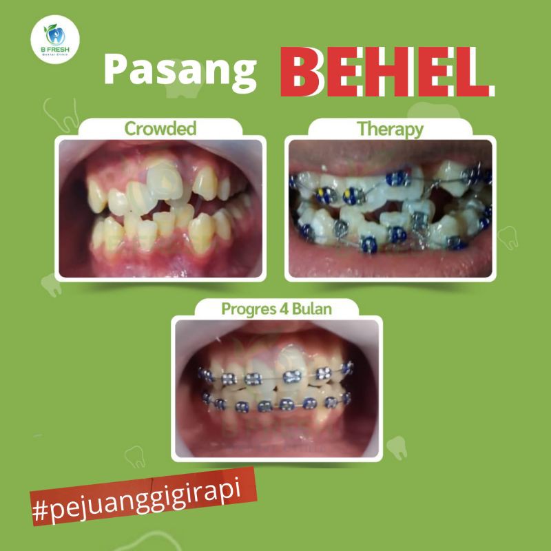 Jual VOUCHER DP PASANG BEHEL KAWAT GIGI BRAKET metal klinik dokter B ...