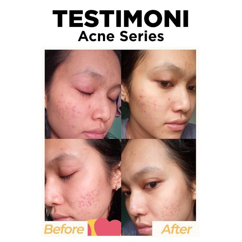 Jual Paket Acne Series | Shopee Indonesia