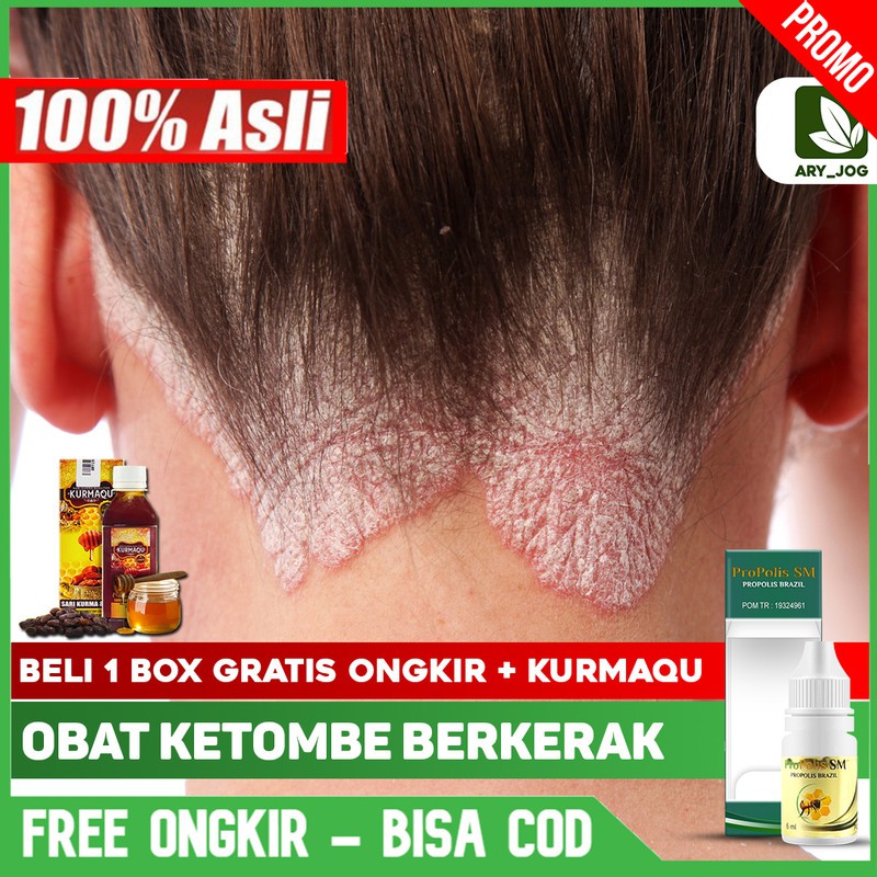 Jual Obat Ketombe Berkerak, Ketombe Kering, Bersisik Kepala Herbal PROPOLIS SM Yogyakarta Bisa ...