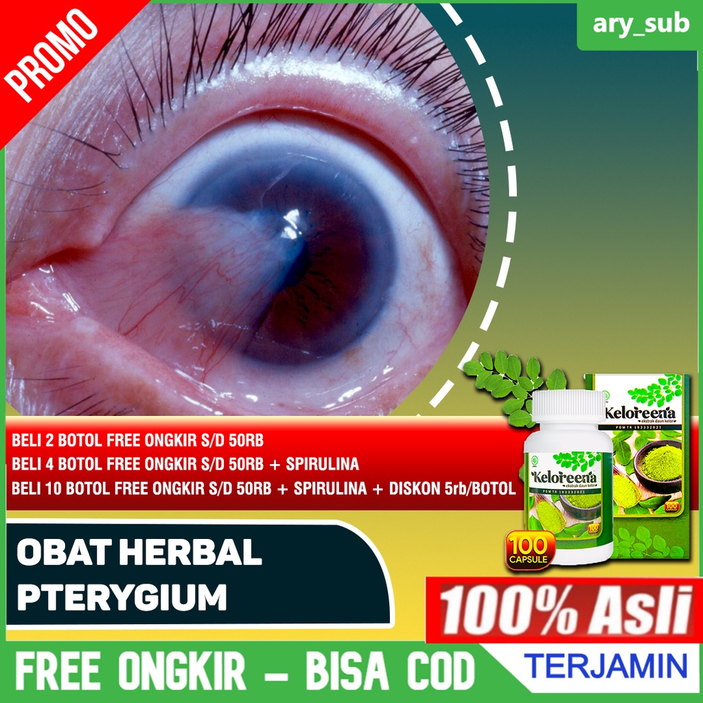 Jual Obat Mata Pterygium, Pembersih Mata Pterigium, Penghilang Lamad Pada Mata, Selaput Putih ...