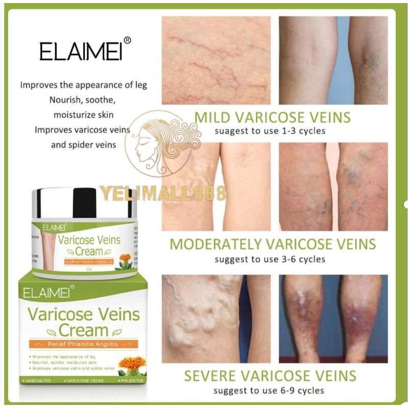 Jual 50 Gr Krim Cream Salep Varises Angiitis Obat Salep Mengobati ...