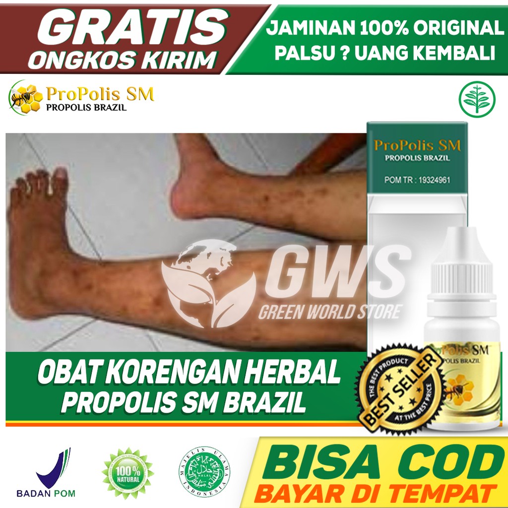 Jual Obat Penghilang Korengan di Kaki - Kepala - Koreng di Wajah ...