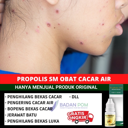 Jual Obat Penghilang Bekas Cacar Air - Obat Pengering Luka Benjolan ...