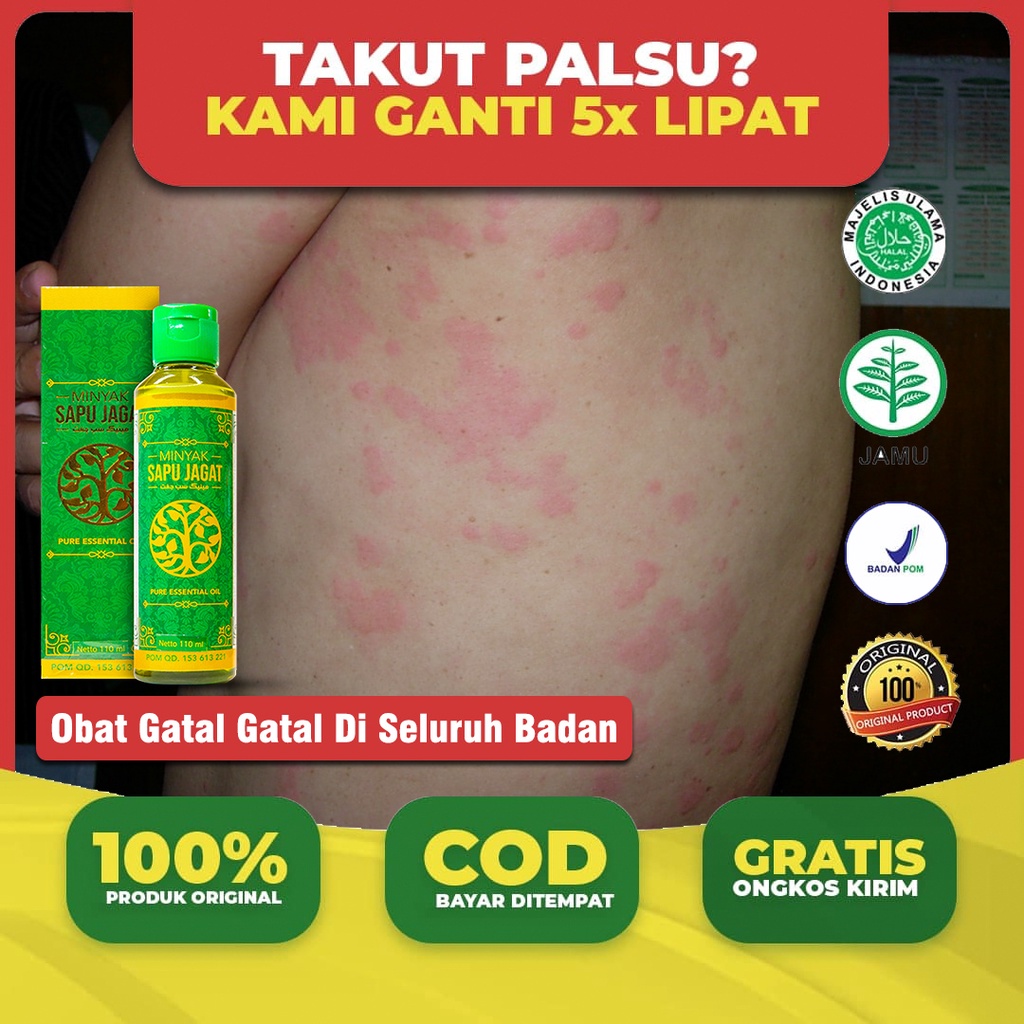 Jual Obat Gatal Gatal Di Seluruh Badan - Bintik bintik Merah - Obat ...