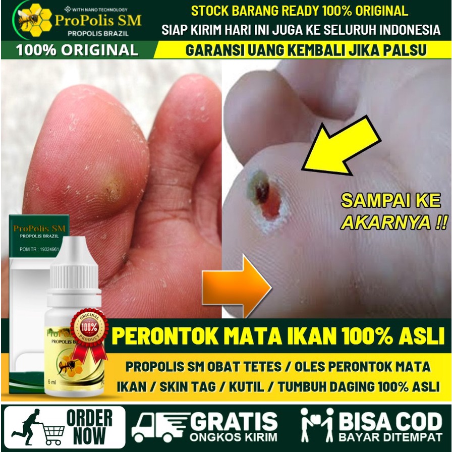 Jual OBAT MATA IKAN HITAM / CLAVUS DI TELAPAK KAKI & TANGAN - Obat ...