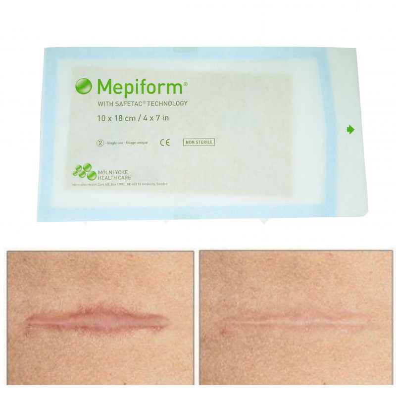 Jual Mepiform Cica Scar Treatment Care Soft Silicone Penghilang Bekas ...
