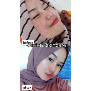 Jual DAVIENA SKINCARE PAKET ACNE SERIES | OFFICIAL STORE | DAVIENA ...