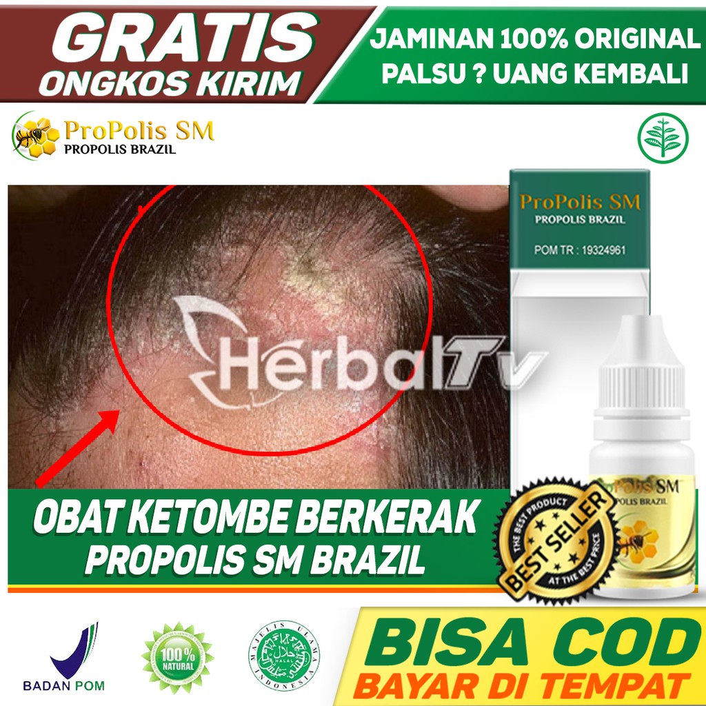 Jual Obat Ketombe di Kepala Sering Gatal - Kulit Berkerak, Penghilang Psoriasis Parah, Borok ...