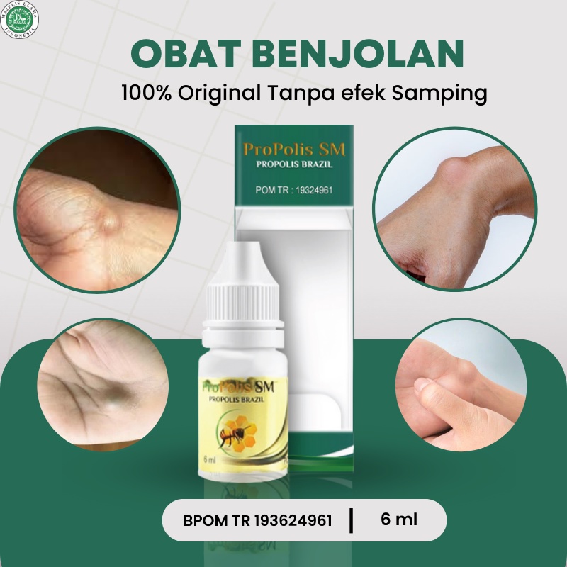 Jual Propolis SM - Obat Benjolan di tangan, Obat Benjolan lipoma, Obat ...