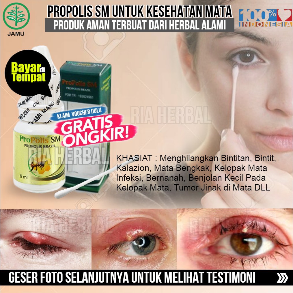 Jual Obat Kalazion Mata Bengkak Bintitan, Benjolan Di Kelopak, Bintilan ...