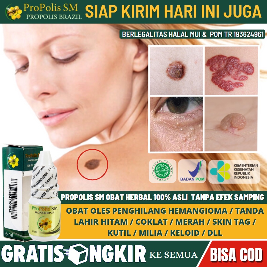 Jual Obat Tahi Lalat Aman Alami, Obat Tahi Lalat di Wajah / Leher ...