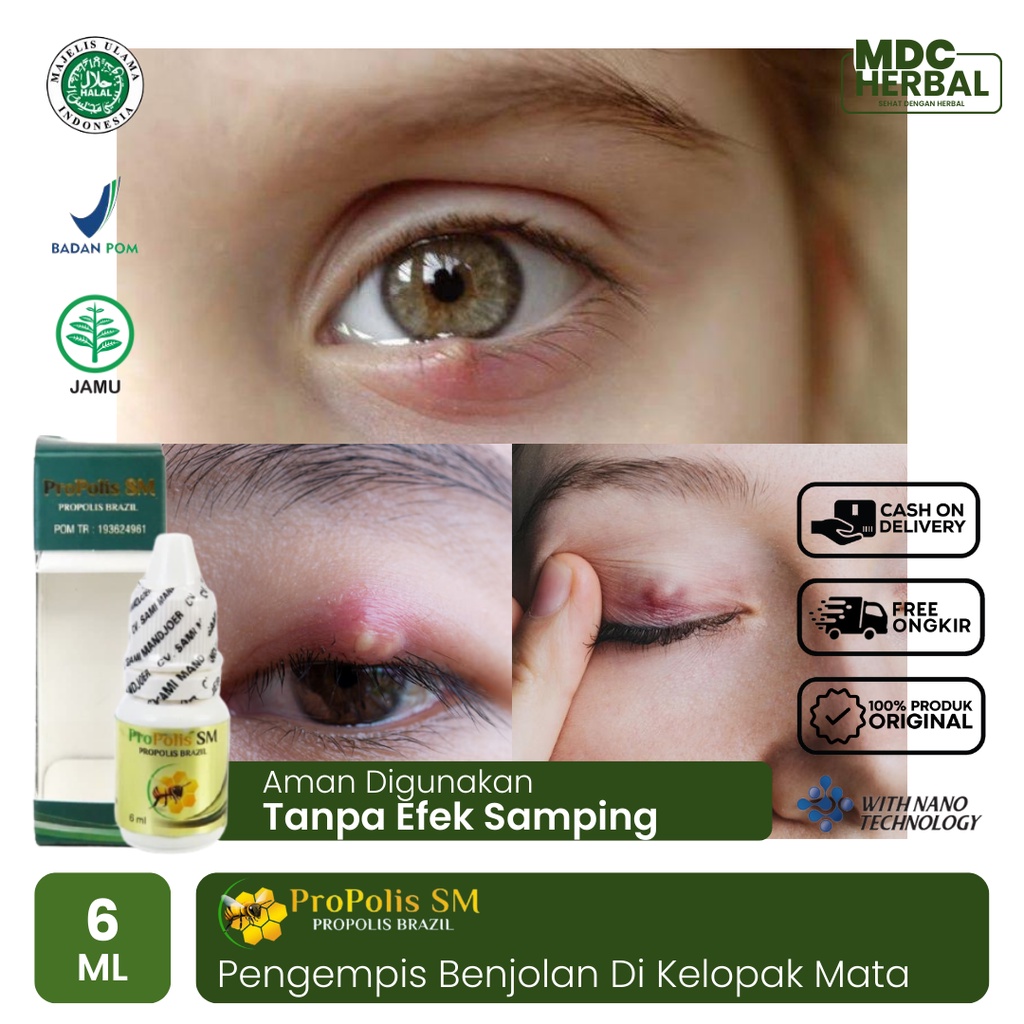 Jual Obat Pengempis Benjolan Kalazion Di Kelopak Mata, Obat Oles Mata ...