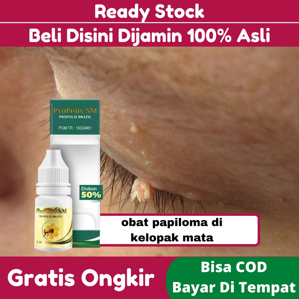 Jual obat papiloma di kelopak mata , Obat Tradisional Papiloma Di Leher ...