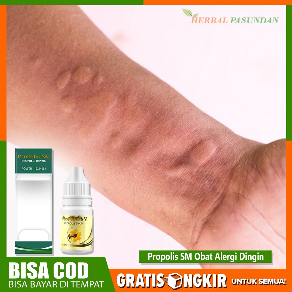 Jual Obat Alergi Cuaca - Cuaca Dingin - Alergi Sinar Matahari - Tubuh ...