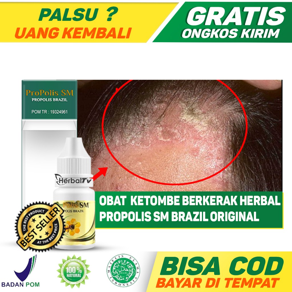 Jual Obat ketombe Berkerak, Borok, Akut, Ketomber Rambut, Ketombe Kulit Kepala Kering Terbaik ...