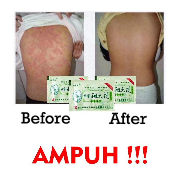 Jual PAKET EKONOMIS 7 SACHET NETTO @3 gram Obat Kulit Gatal Jerawat ...