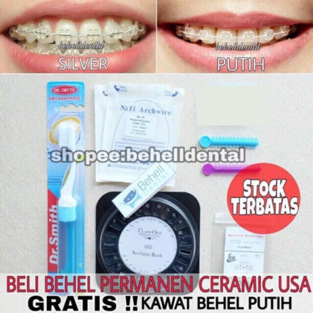 Jual PAKET Behel Permanen Ceramic transfaran.Kawat gigi Classone Usa ...