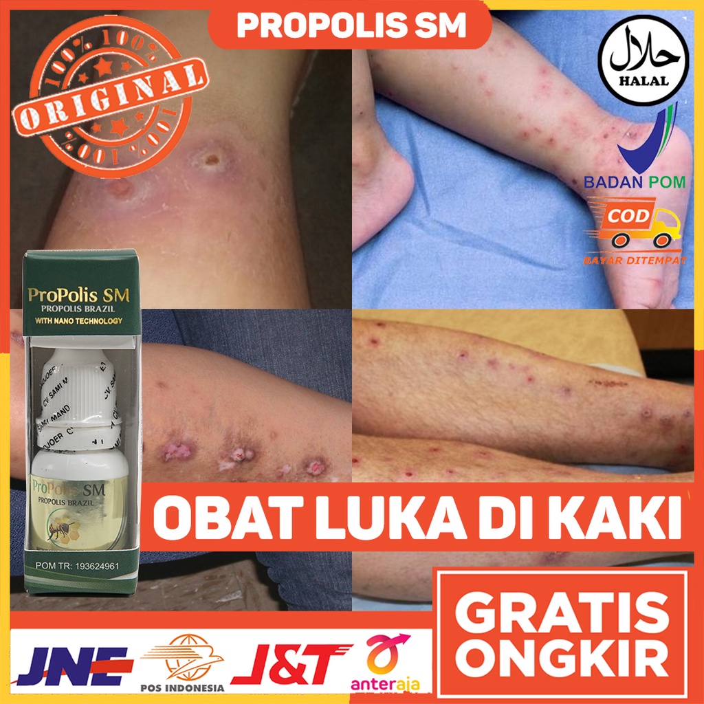 Jual Obat Luka di Kaki - Obat Luka Bernanah - Obat Luka Berdarah - Obat ...