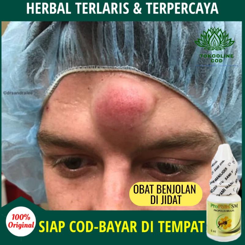 Jual Obat Benjolan di Jidat, Benjolan di Dahi, Benjolan di Kening ...