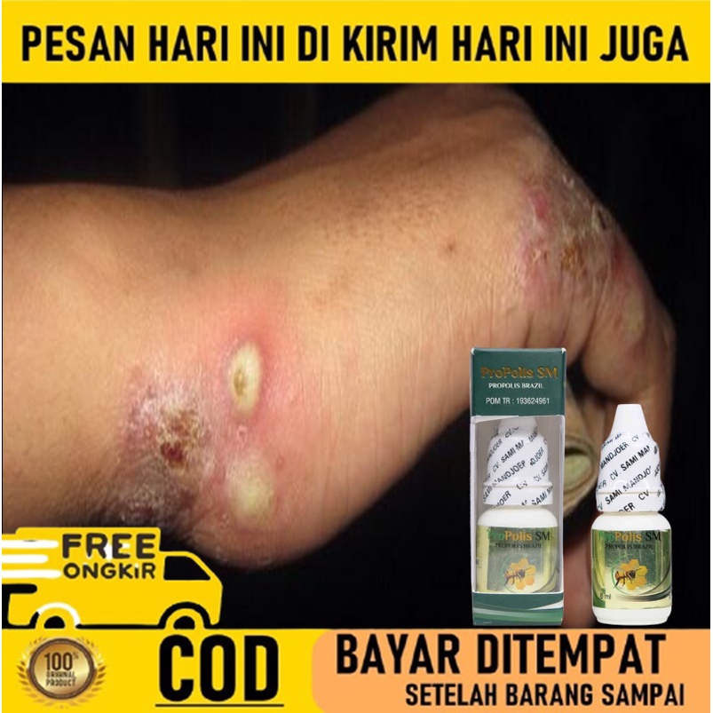 Jual Salep gudik - Obat gudik bernanah - Obat Scabies manusia - Obat ... Jual Salep gudik - Obat gudik bernanah - Obat Scabies manusia - Obat ...