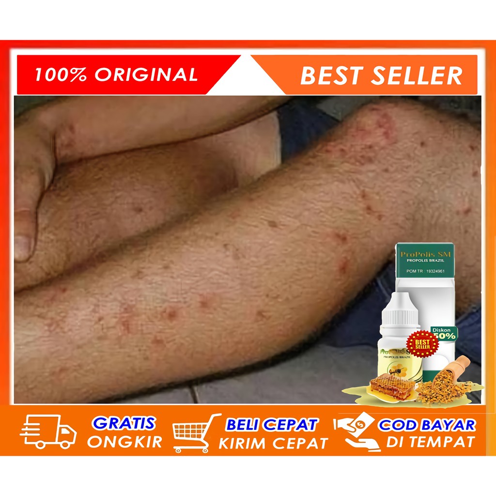Jual Obat Penghilang Koreng di Kaki Paling Laris, Salep Bekas Luka ...