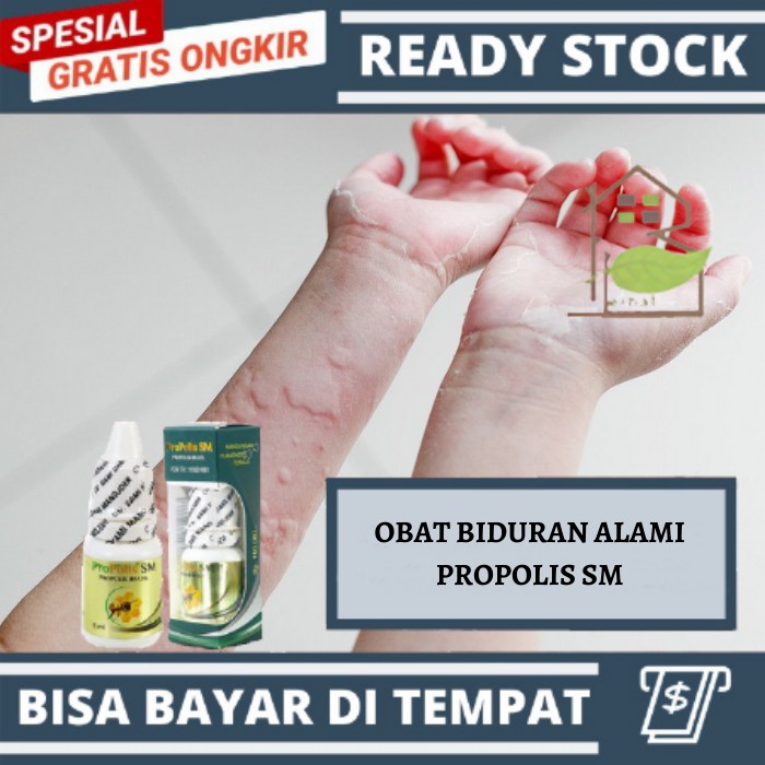 Jual Obat Biduran ORI, Alergi Dingin, Kaligata, Gatal-Gatal Eksim, Ruam ...