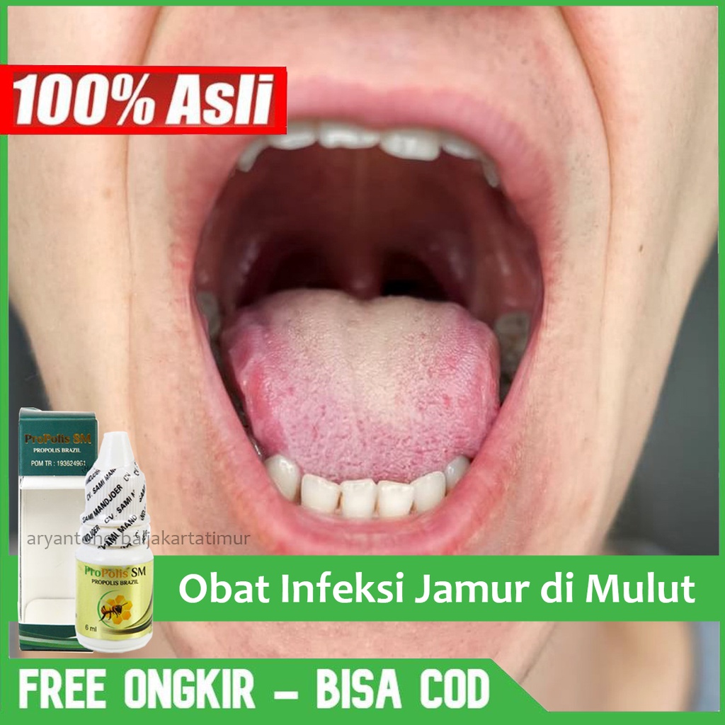 Jual Propolis SM Obat Infeksi Jamur di Mulut Kandidiasis Oral Bercak ...