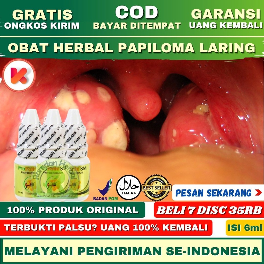 Jual Obat Papiloma Laring Tumor Jinak Obat Herbal Papiloma PROPOLIS SM ...