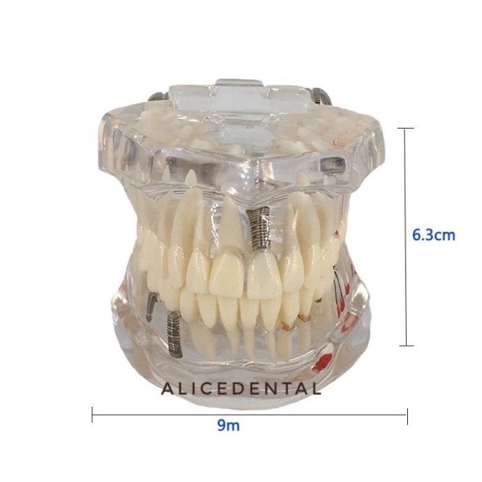 Jual Model studi gigi implant crown bridge bening transparan phantom ...
