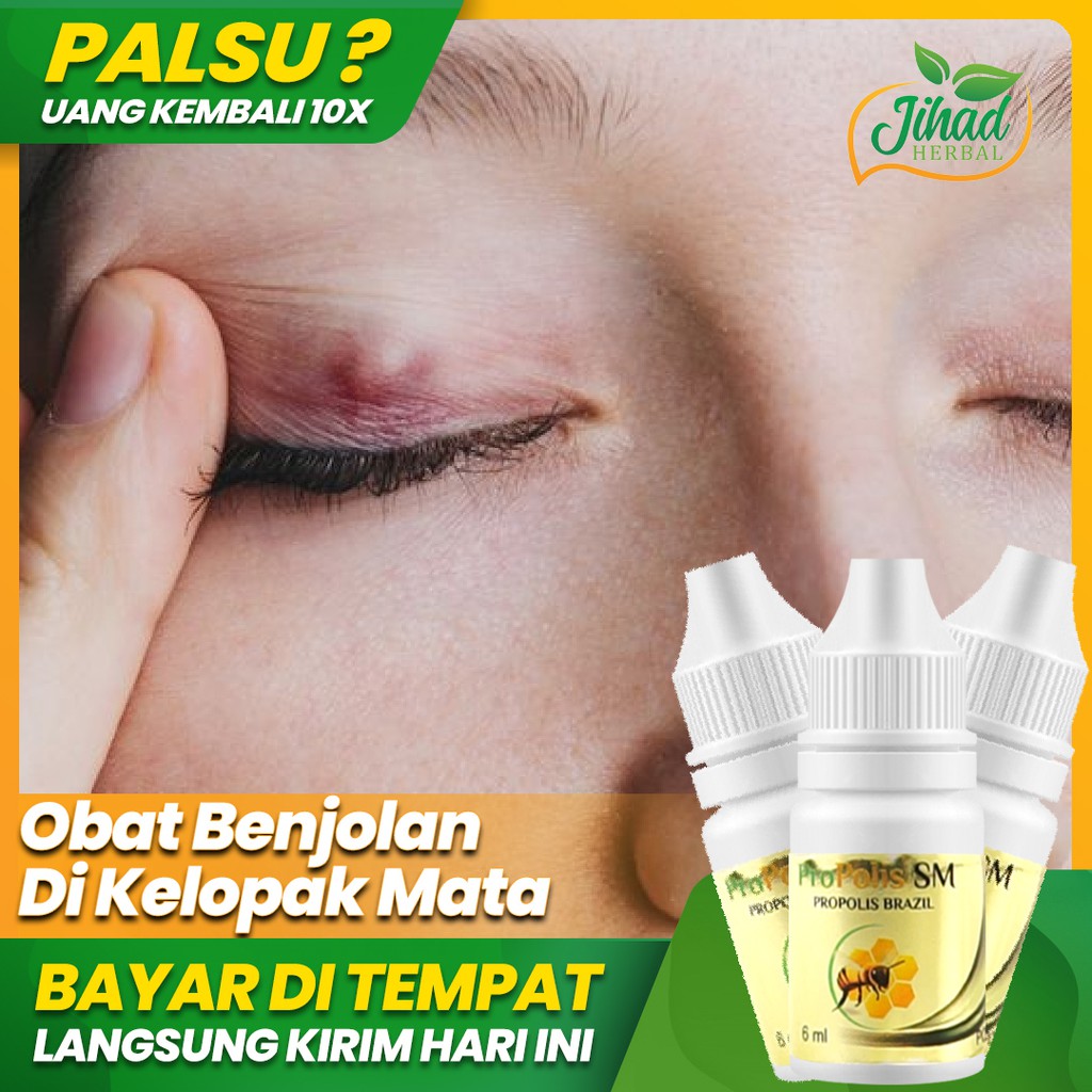 Jual Propolis Obat Benjolan di Kelopak Mata, Penyakit Mata Bintitan ...