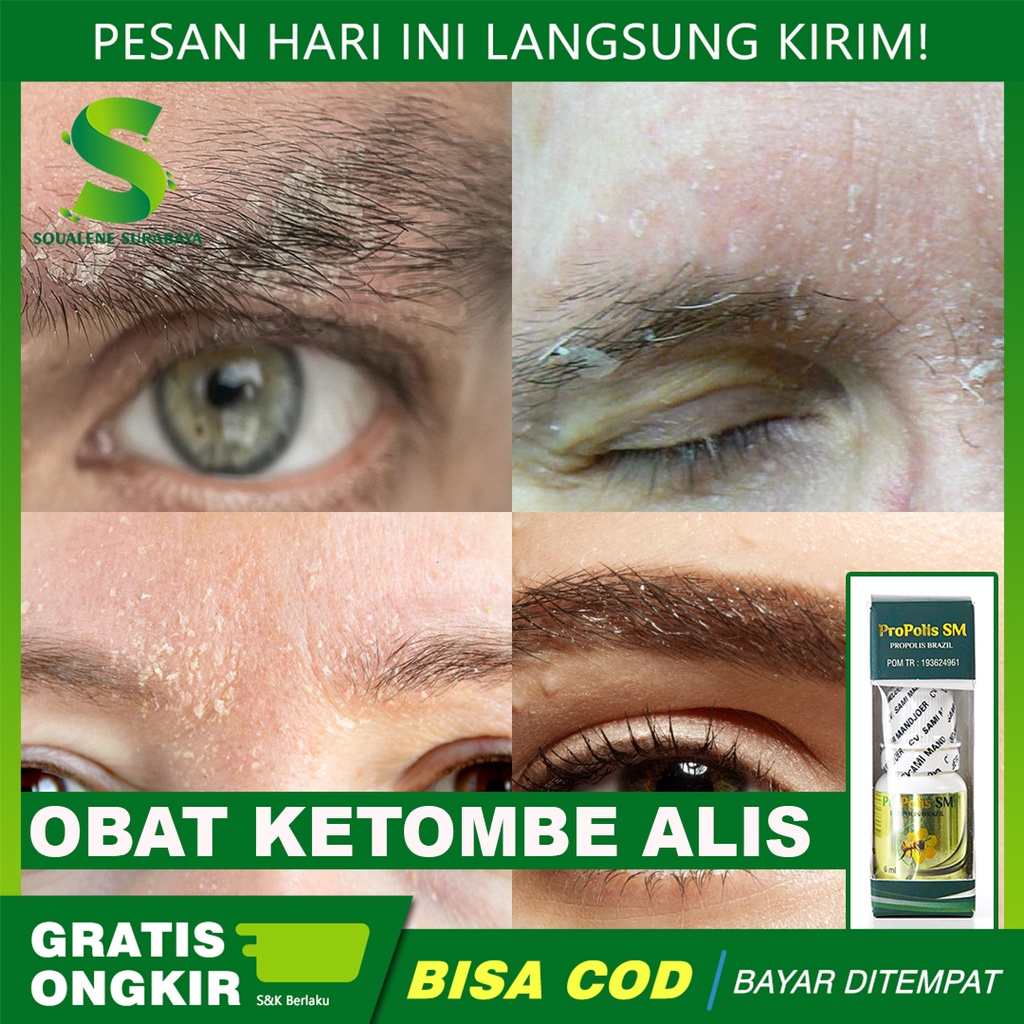 Jual Obat Ketombe Alis - Pembersih Ketombe - Ketombe di Kepala - Ketombe Berkerak - Kulit Kepala ...