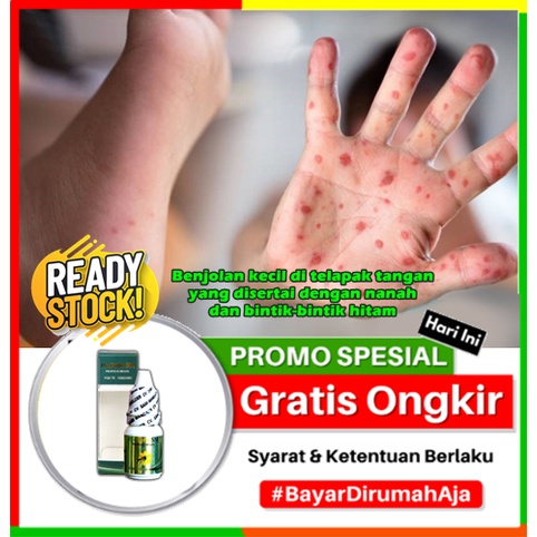 Jual Benjolan kecil di telapak tangan yang disertai dengan nanah dan ...