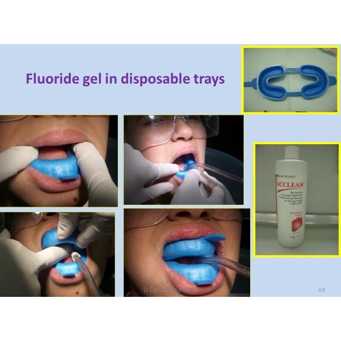 Jual Tray Topical Topikal Fluoride Foam / Sendok Cetak Topical | Shopee ...