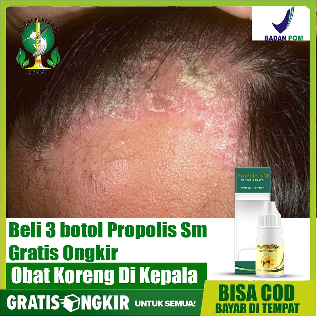Jual Propolis Sm Obat Koreng di Kepala, Obat Ketombe, Obat Psoriaris, Obat Ketombe Berkerak di ...