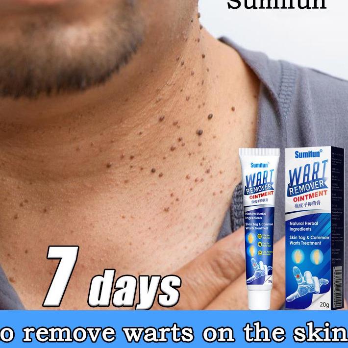 Jual 8.8 SALE Warts Remover Cream Wart Treatment Skin Tags Mole Remover ...